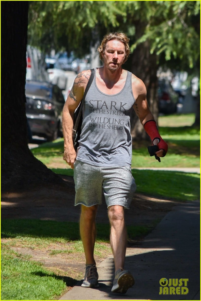Dax Shepard Steps Out in a Cast After Performing Surgery on Himself ...