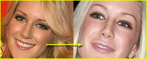 Heidi Montag Has New Lips | Heidi Montag : Just Jared